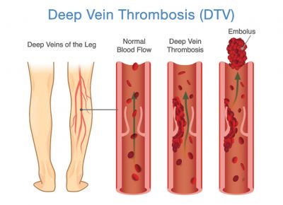Warning Signs Of DVT - Vein Institute Of Pinellas