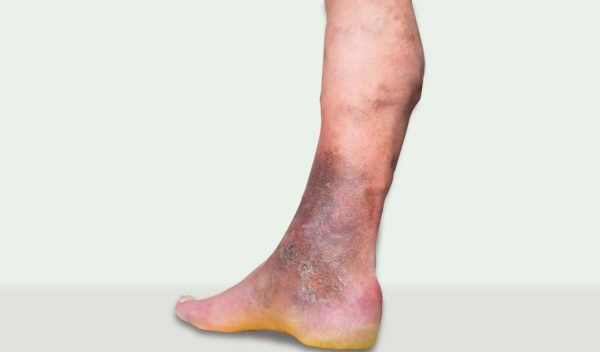 Ankle Discoloration Causes And Treatment - Vein Institute Of Pinellas