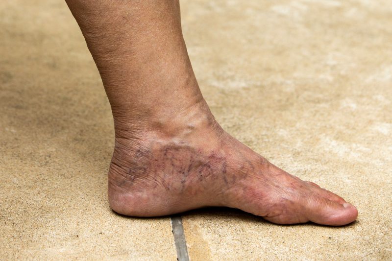 Understanding Varicose Veins In The Feet - Vein Institute Of Pinellas