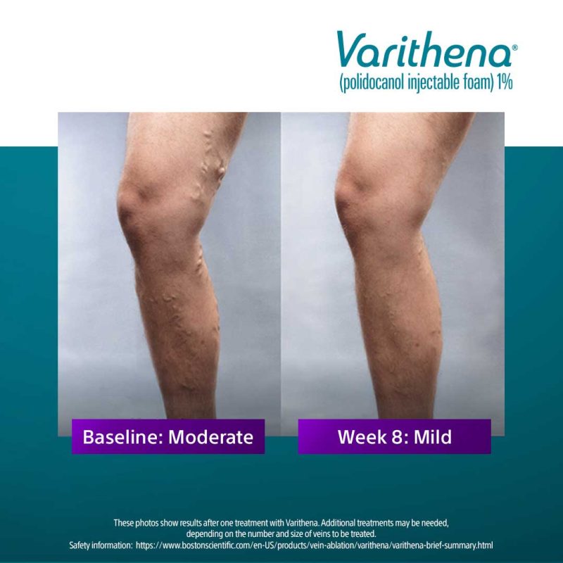 Varithena For Varicose Veins | Boost Vein Health